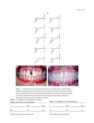 Tissue reaction to orthodontic tooth movement-a new paradigm | RTF