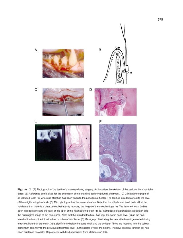 Tissue reaction to orthodontic tooth movement-a new paradigm | RTF ...