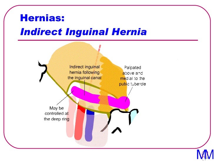 004 Hernias - Introduction to Clinical Surgery Lectures