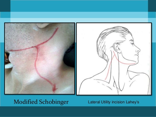 Surgical anatomy and approaches to neck