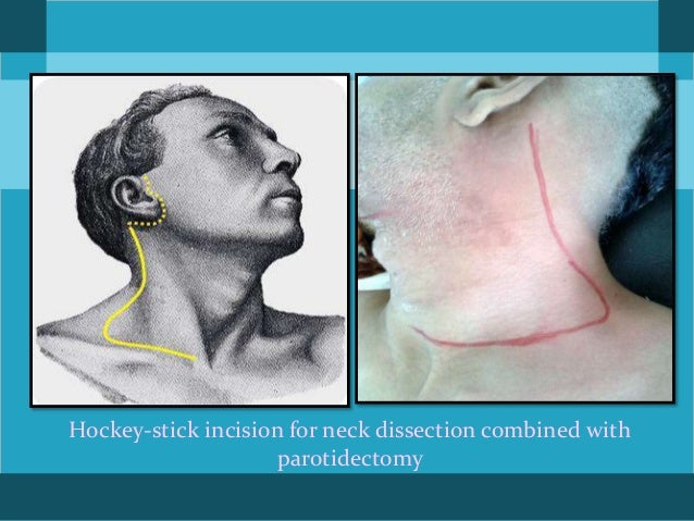 Surgical anatomy and approaches to neck