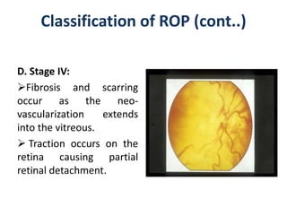 seminar on ROP - retinopathy of prematurity | PPT