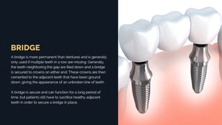 Replacement Teeth Options | PDF