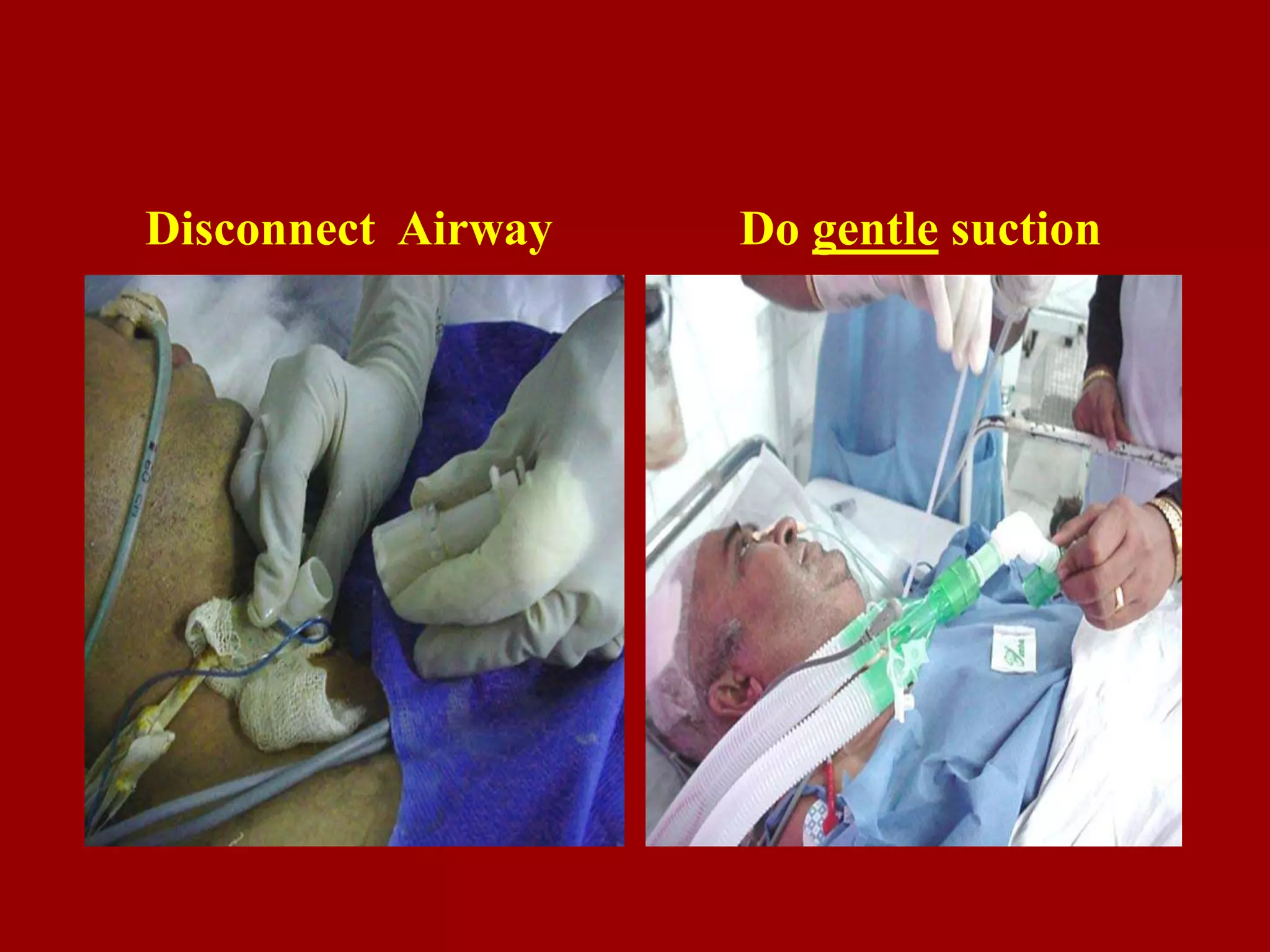 005 Suctioning.ppt