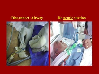 005 Suctioning.ppt