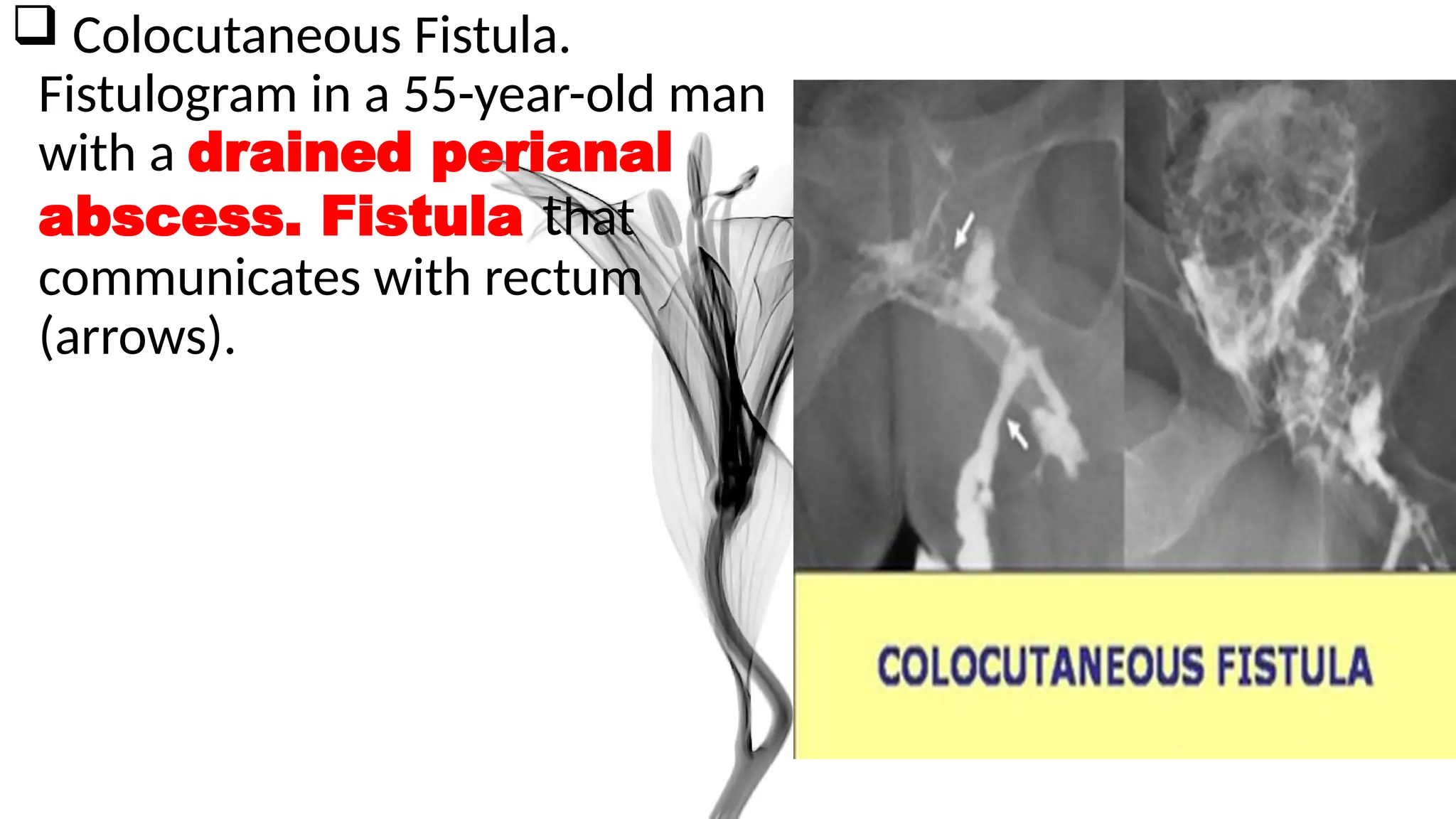 0061 FISTULOGRAPHY - Copy.pptxmmmmmmmmmmmmmmmmmmmmmmm | PPTX
