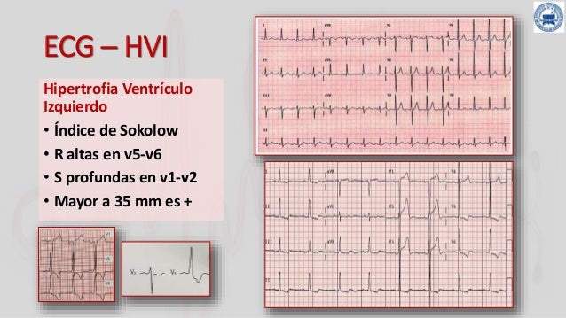 007 electrocardiograma segunda parte