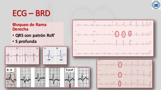 007 electrocardiograma segunda parte