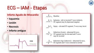 Electrocardiograma De Infarto De Miocardio Lateral