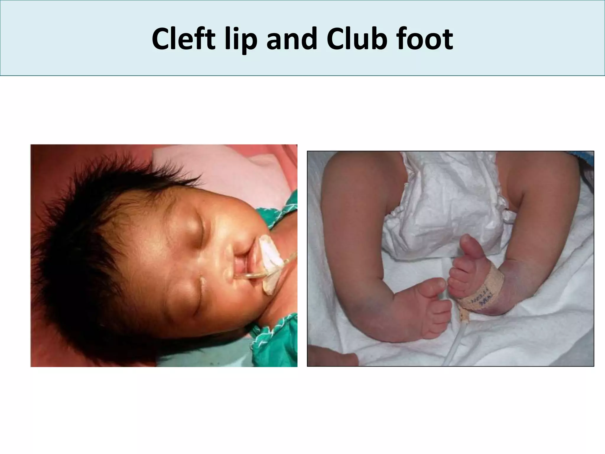 seminar birth defect | PPT | Pregnancy | Reproductive Health