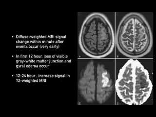 009 youmans cerebral edema | PDF