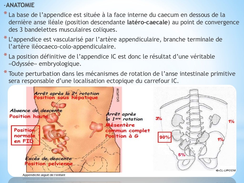 Appendicite Aigu appendicite-aigu