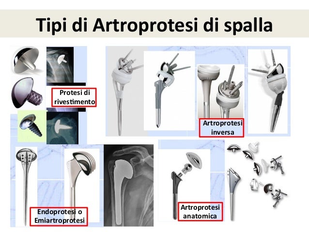 Taddio Nicola SICSG Bologna 2018 Riabilitazione della spalla protesiz…