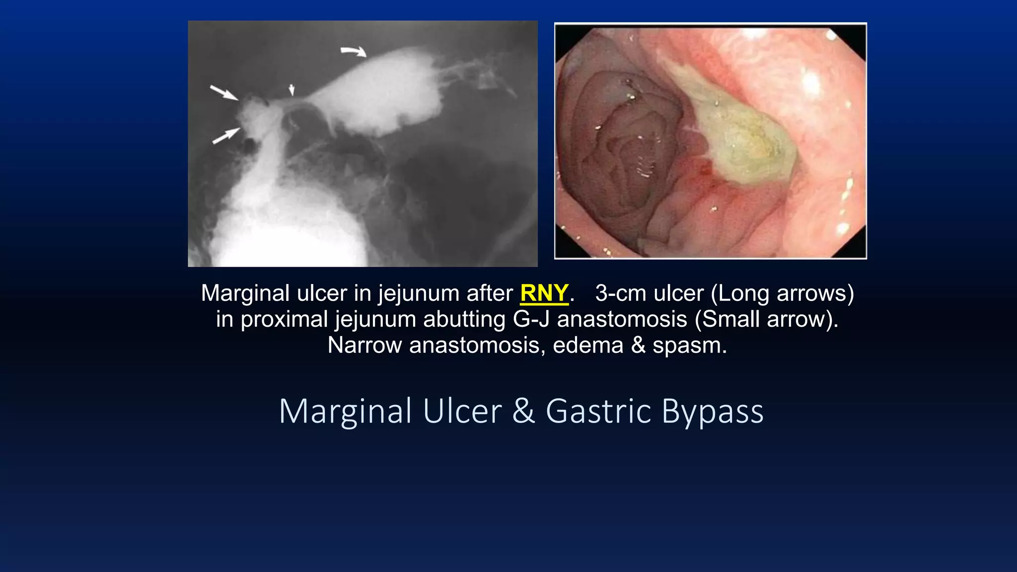 Surgeons' Confusion & Misunderstanding the MGB: Bile, Bile Reflux, Bile ...