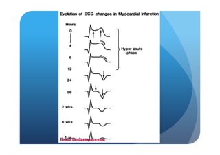 Cardiac Biomarkers in ACS | PDF