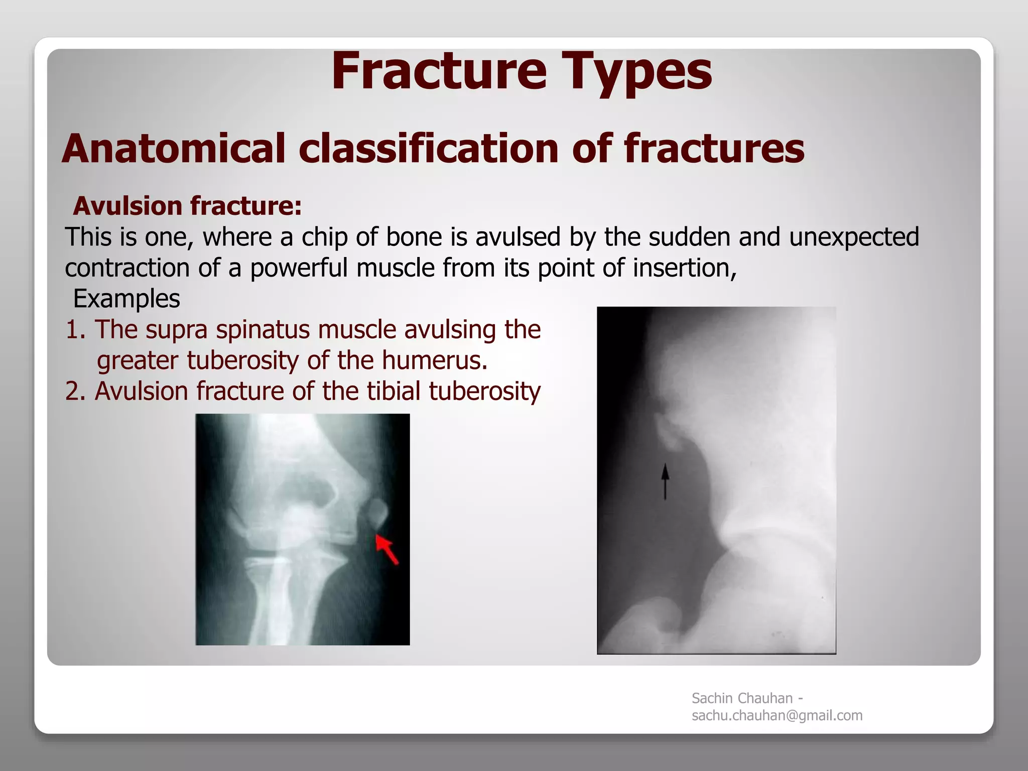 Fracture - Types, complications and management | PPTX