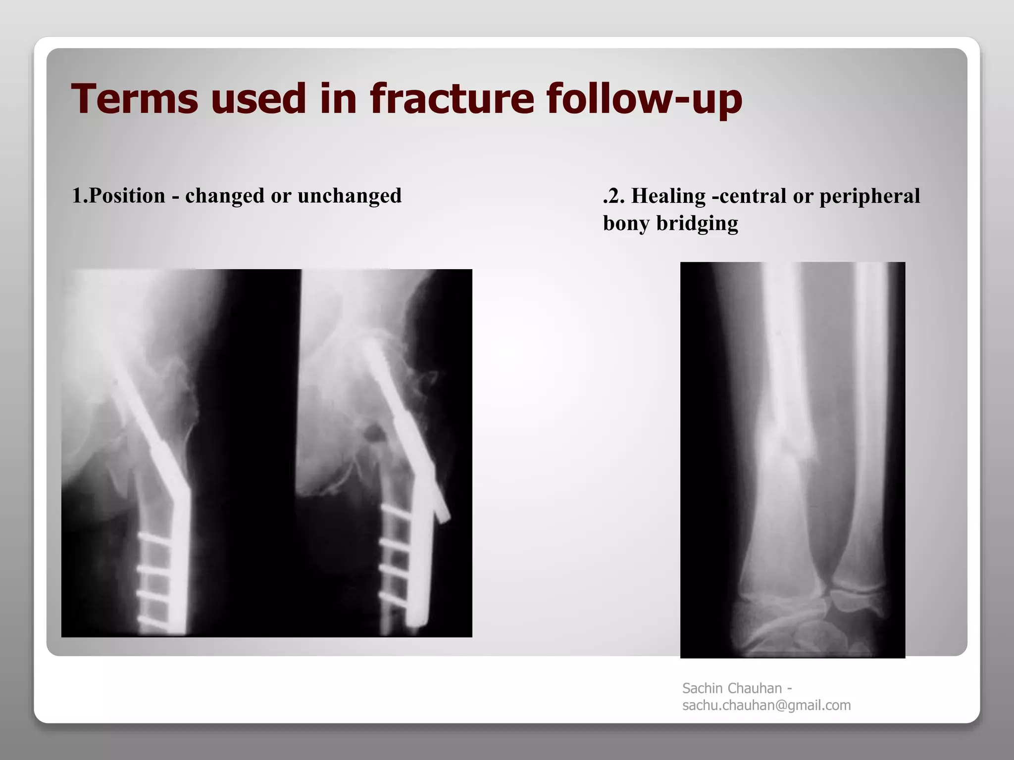 Fracture - Types, complications and management | PPTX