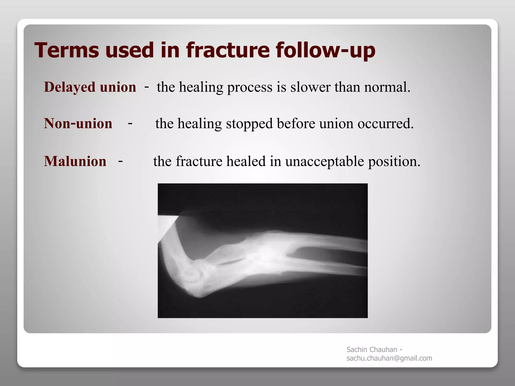 Fracture - Types, complications and management | PPTX