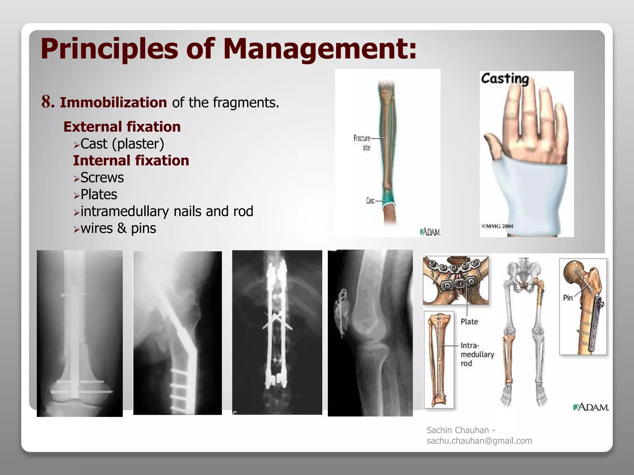 Fracture - Types, complications and management | PPTX