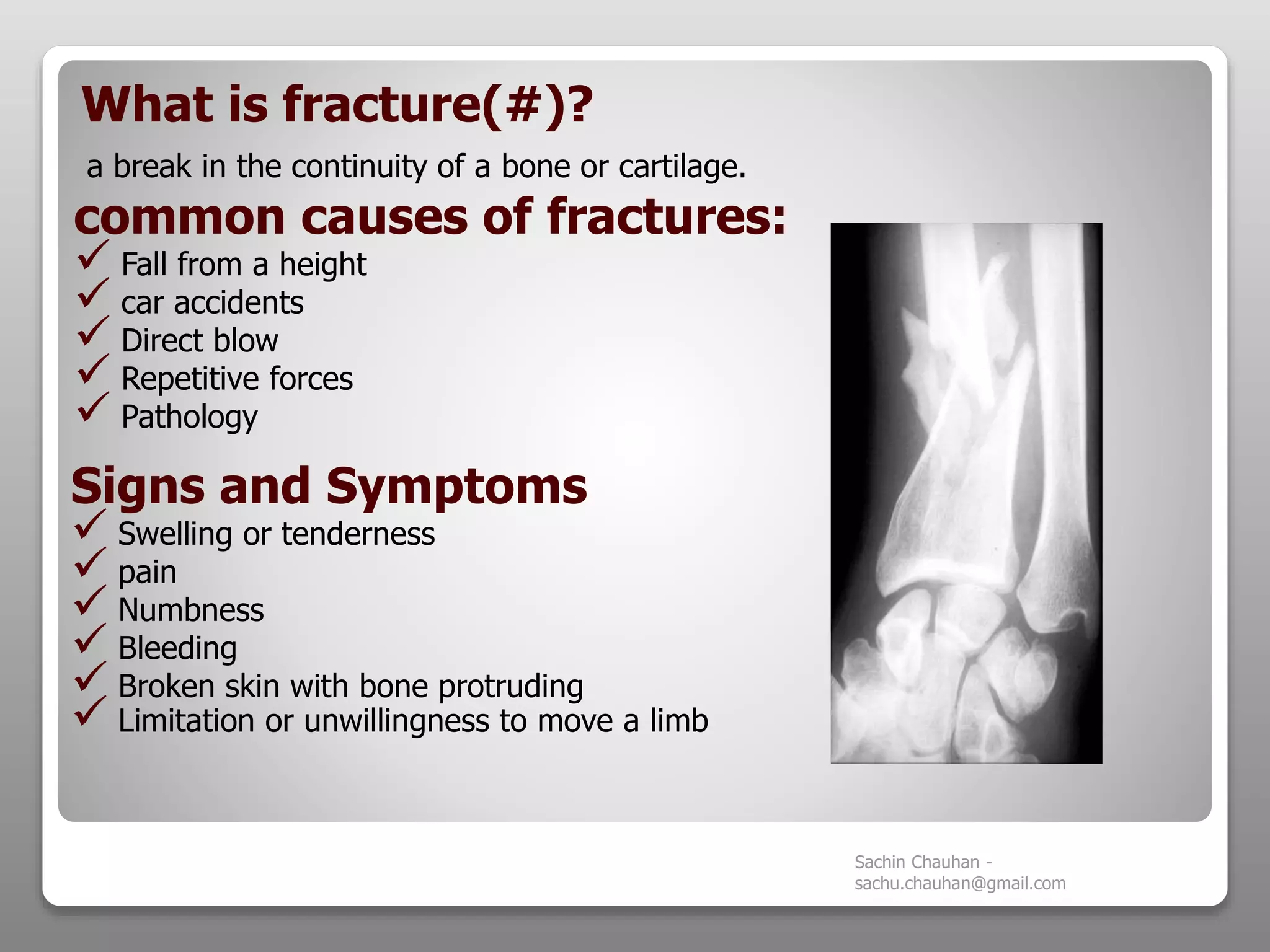 Fracture - Types, complications and management | PPTX