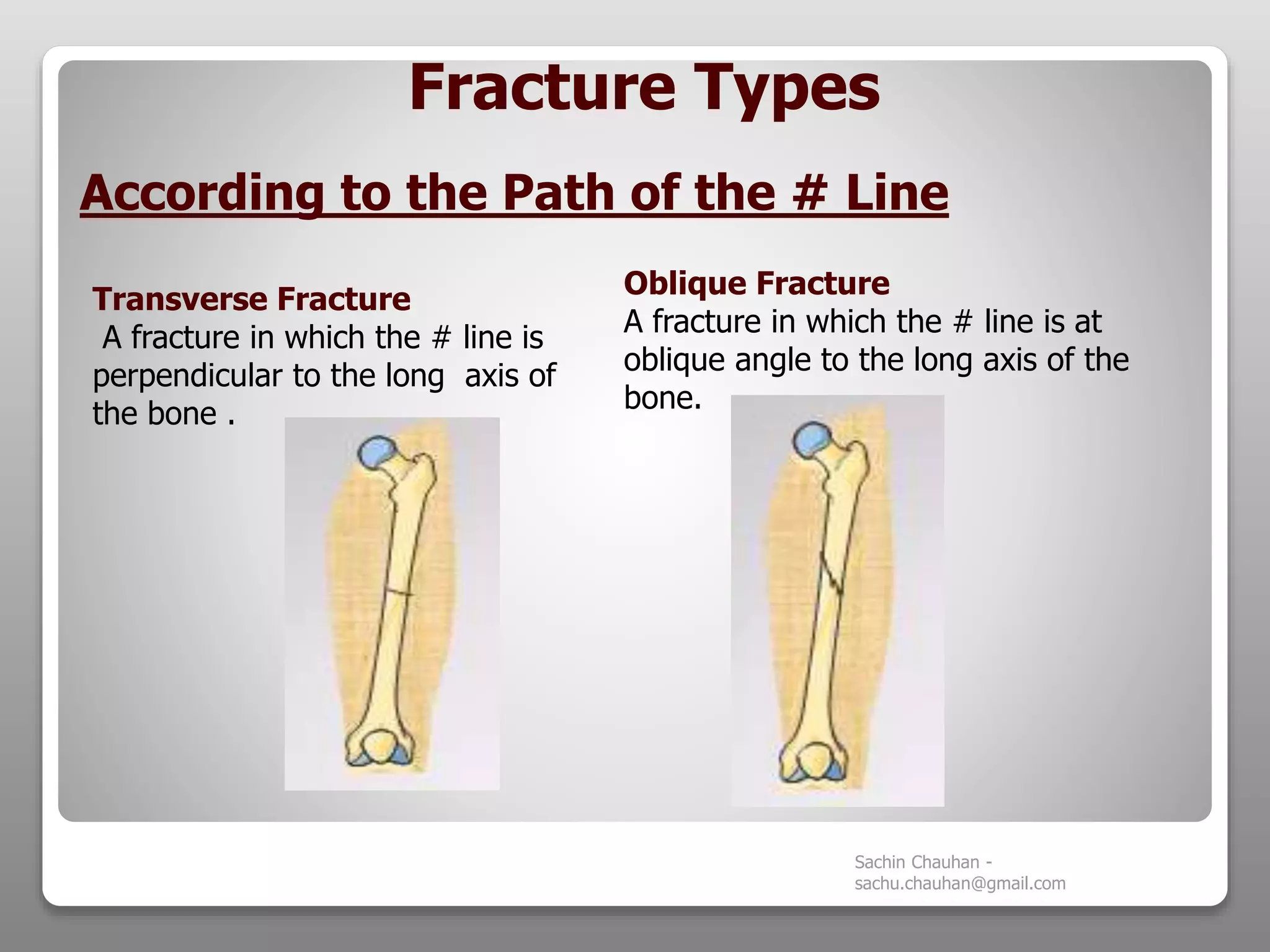 Fracture - Types, complications and management | PPTX