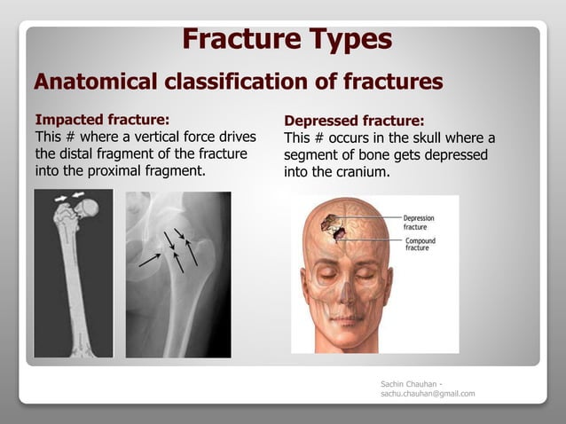 Fracture - Types, complications and management | PPTX