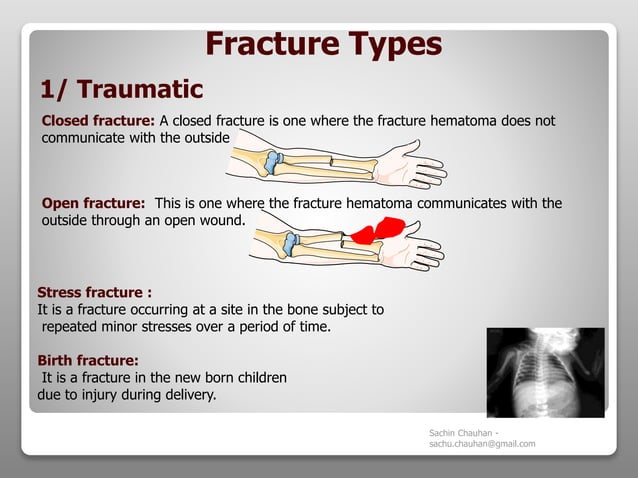 Fracture - Types, complications and management | PPTX