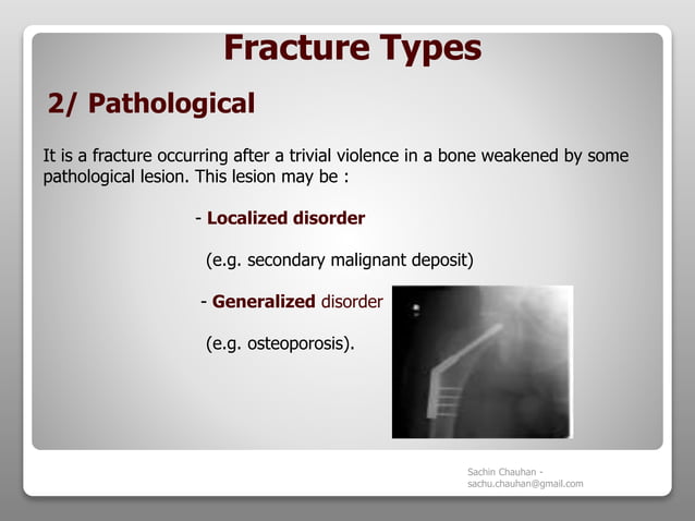 Fracture - Types, complications and management | PPTX