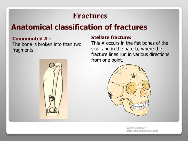 Fracture - Types, complications and management | PPTX