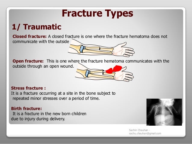 Fracture - Types, complications and management