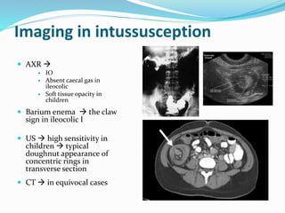 Intussusception Claw Sign