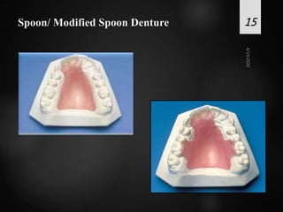 01. removable partial denture | PPTX