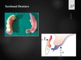 01. removable partial denture | PPTX