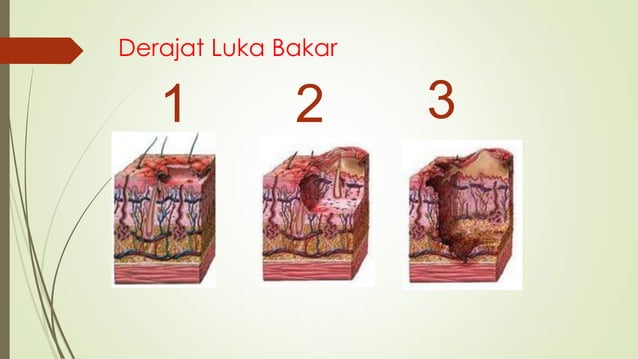 01. Konsep Luka Bakar, Iwanta R.pdf