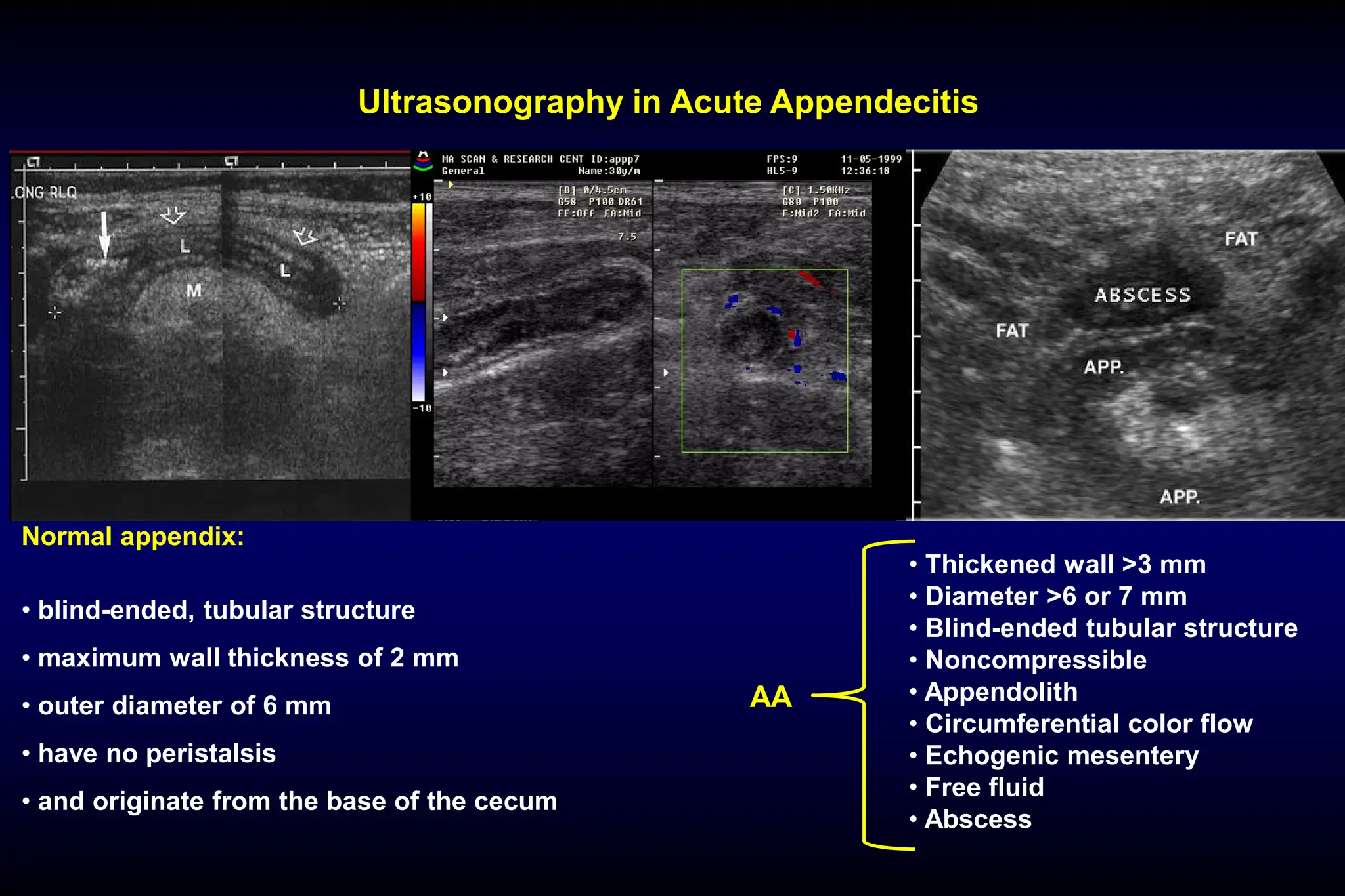 01.Acute appendicitis and chronic appendicitis.pdf