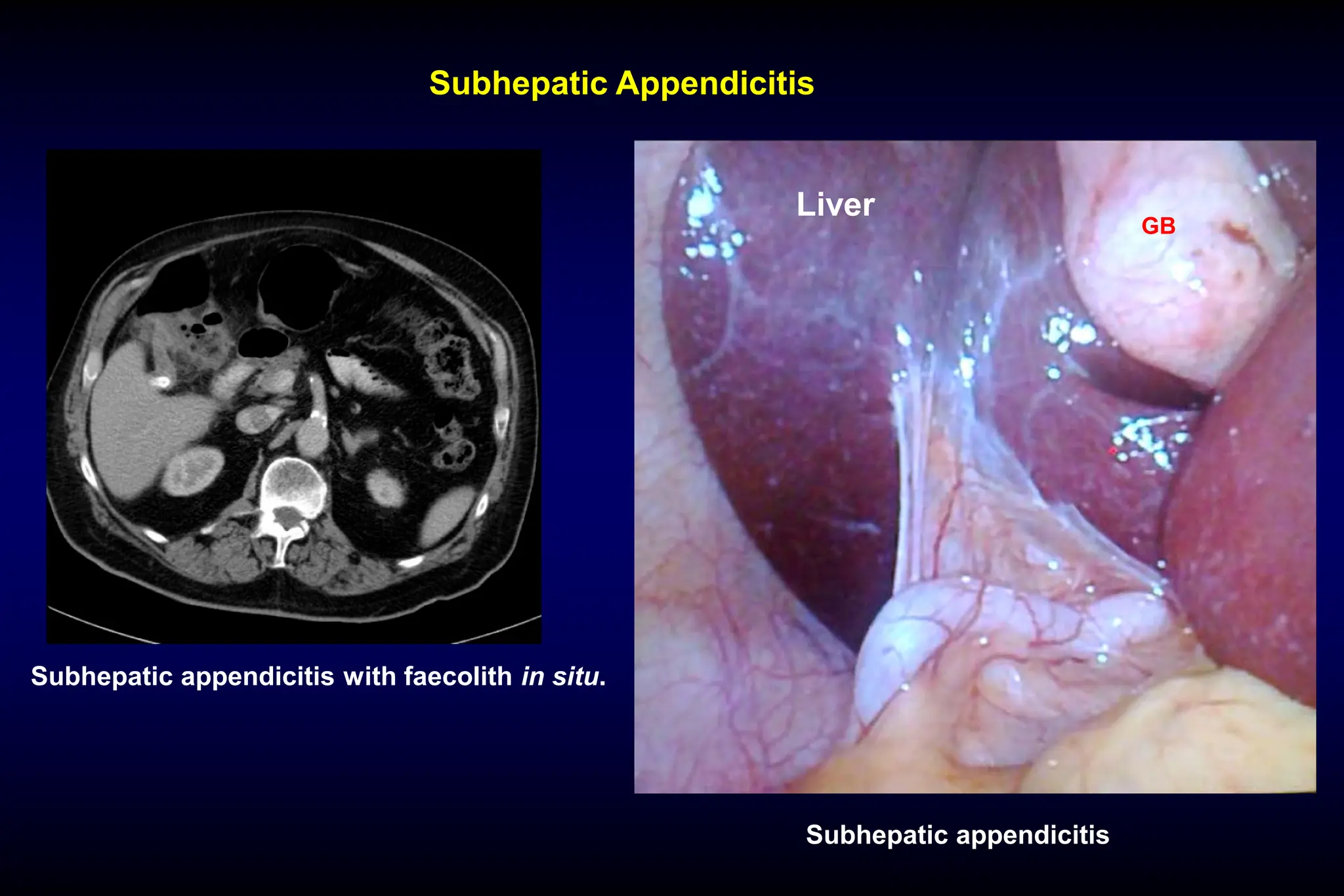 01.Acute appendicitis and chronic appendicitis.pdf