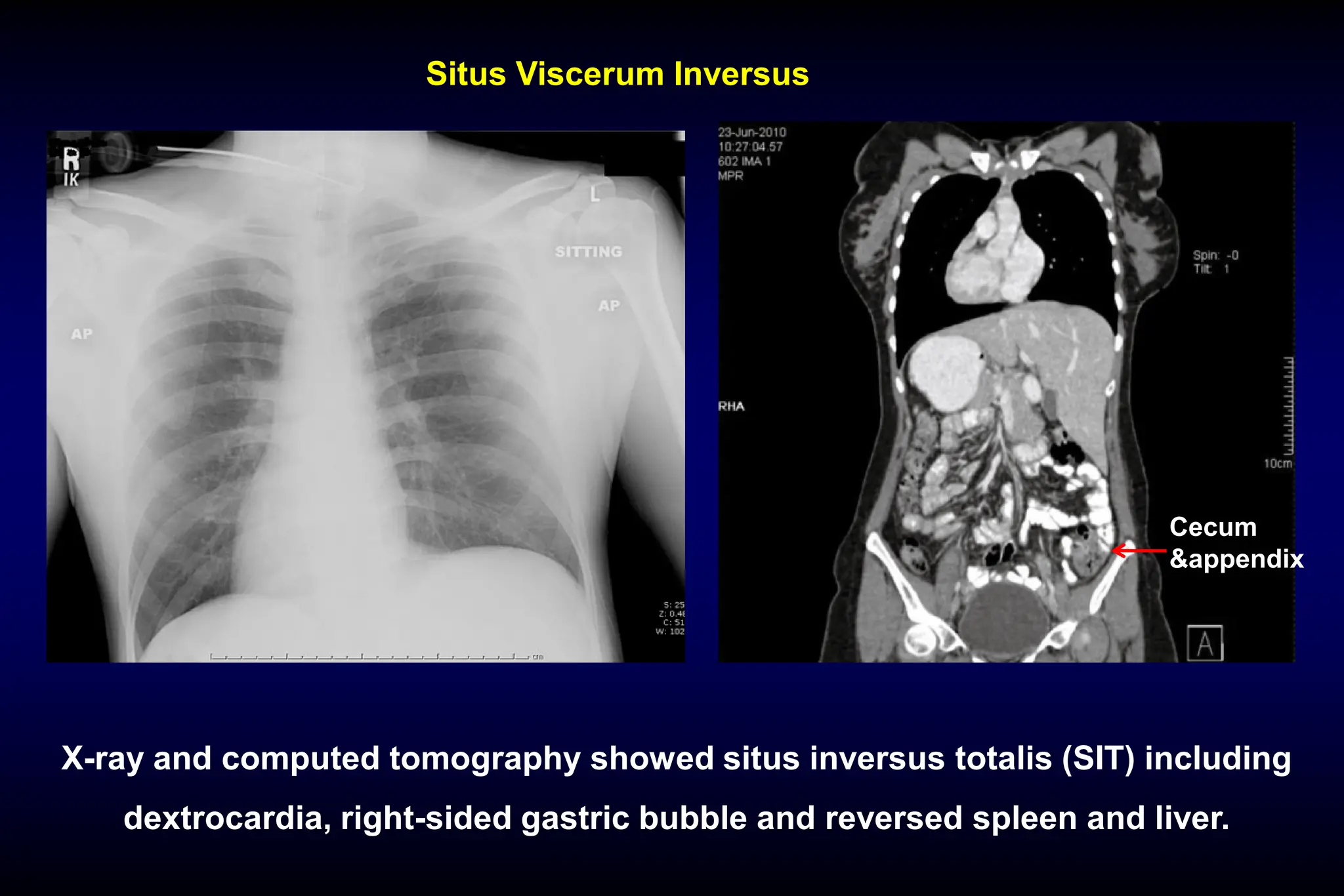 01.Acute appendicitis and chronic appendicitis.pdf