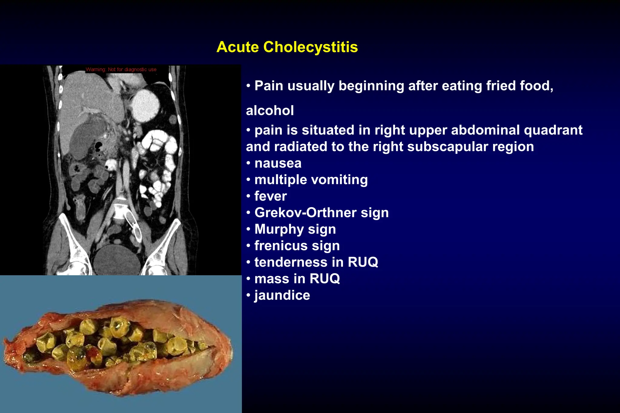 01.Acute appendicitis and chronic appendicitis.pdf