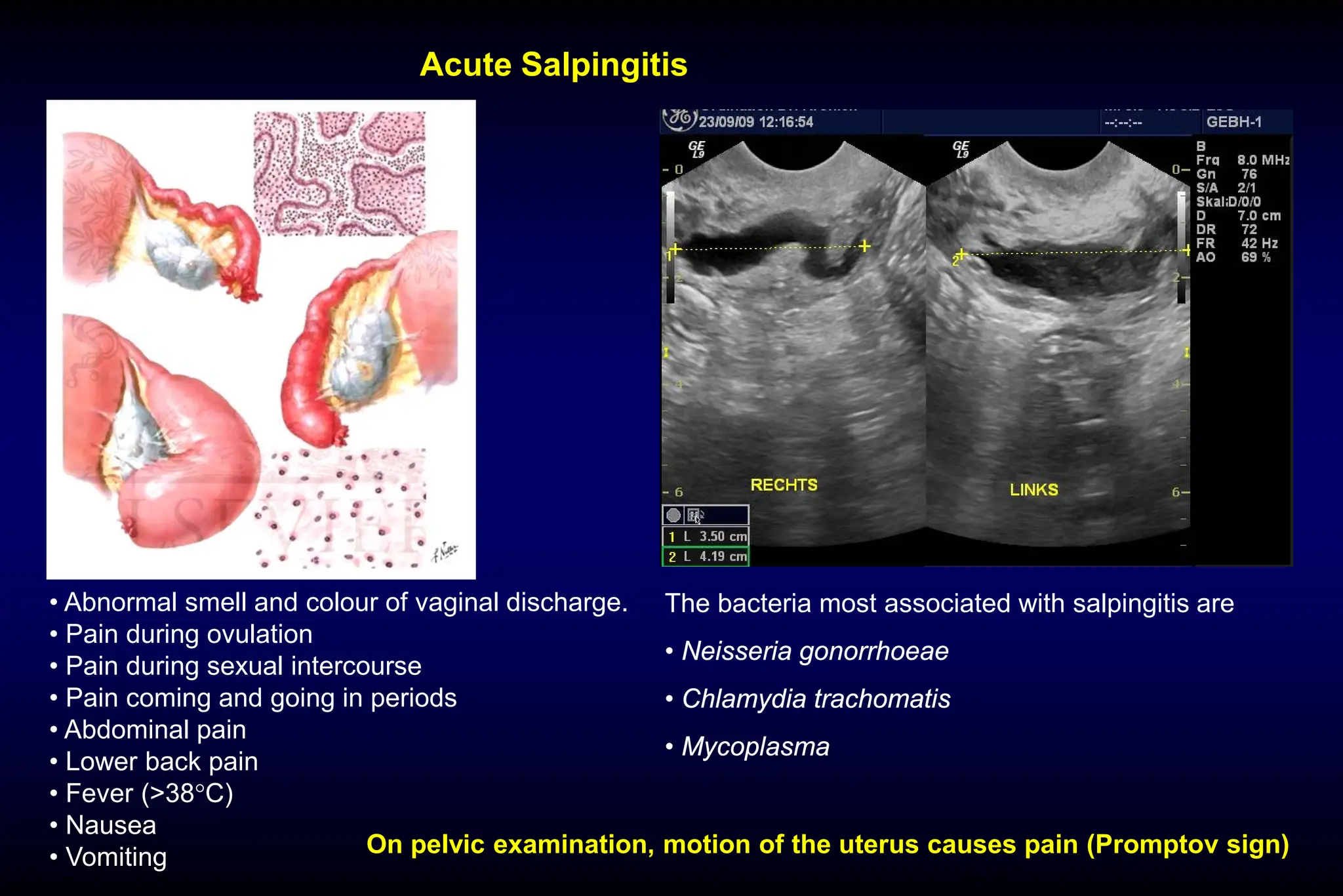 01.Acute appendicitis and chronic appendicitis.pdf
