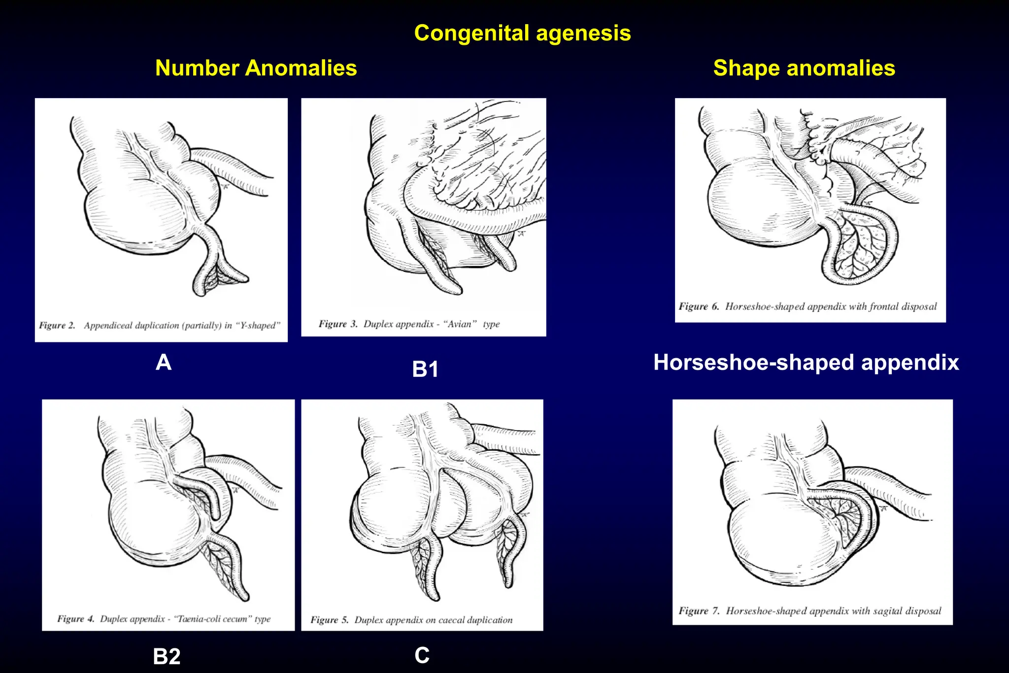 01.Acute appendicitis and chronic appendicitis.pdf