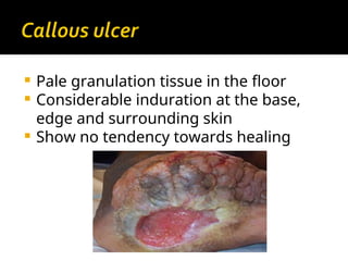 ULCERS Classification and management.ppt