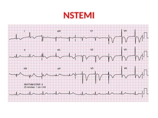 Acute Coronary Syndrome(unstable angina, NSTEMI, STEMI) .pptx