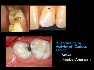 01. Cavity Classification & Nom 2023 ---.pdf
