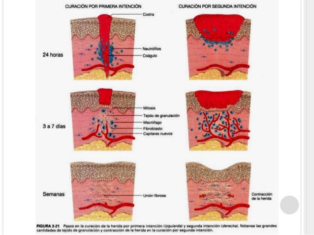 proceso de la inflamacion