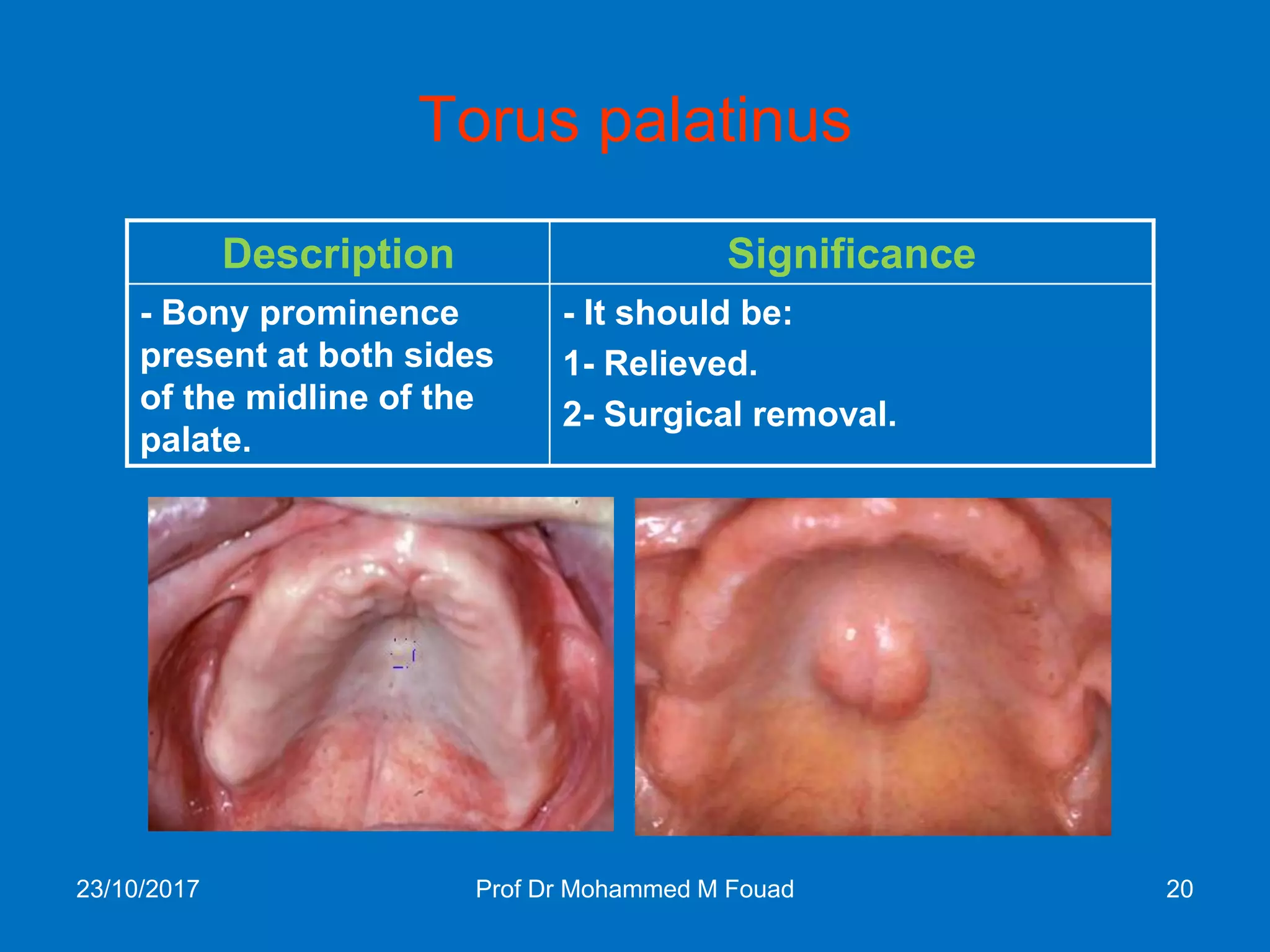 Intraoral Anatomical Landmarks | PDF