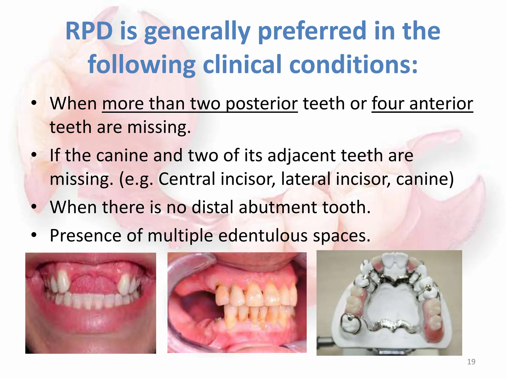 01- INTRODUCTION AND CLASSIFICATION PARTIAL DENTURE.pptx