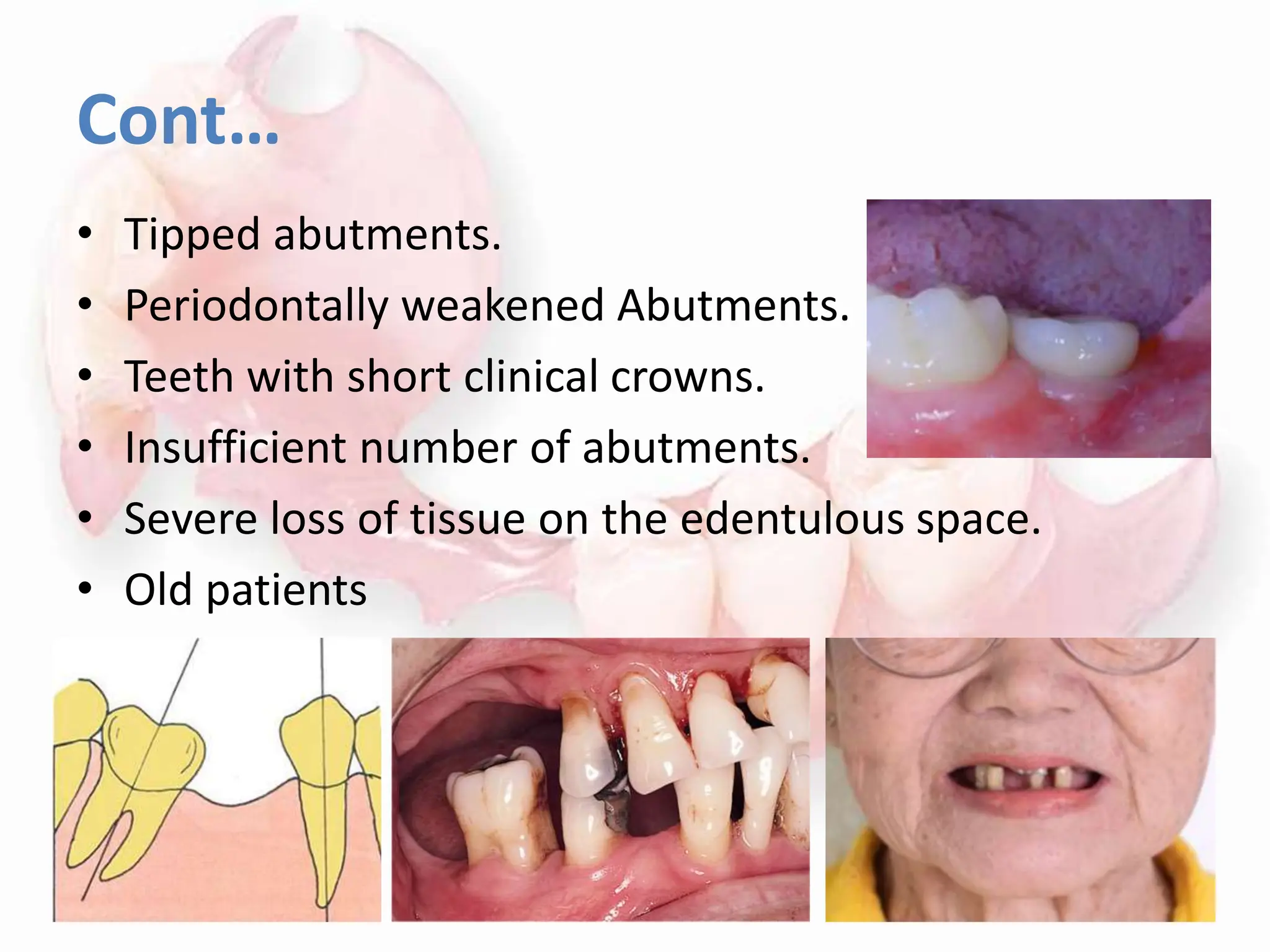 01- INTRODUCTION AND CLASSIFICATION PARTIAL DENTURE.pptx