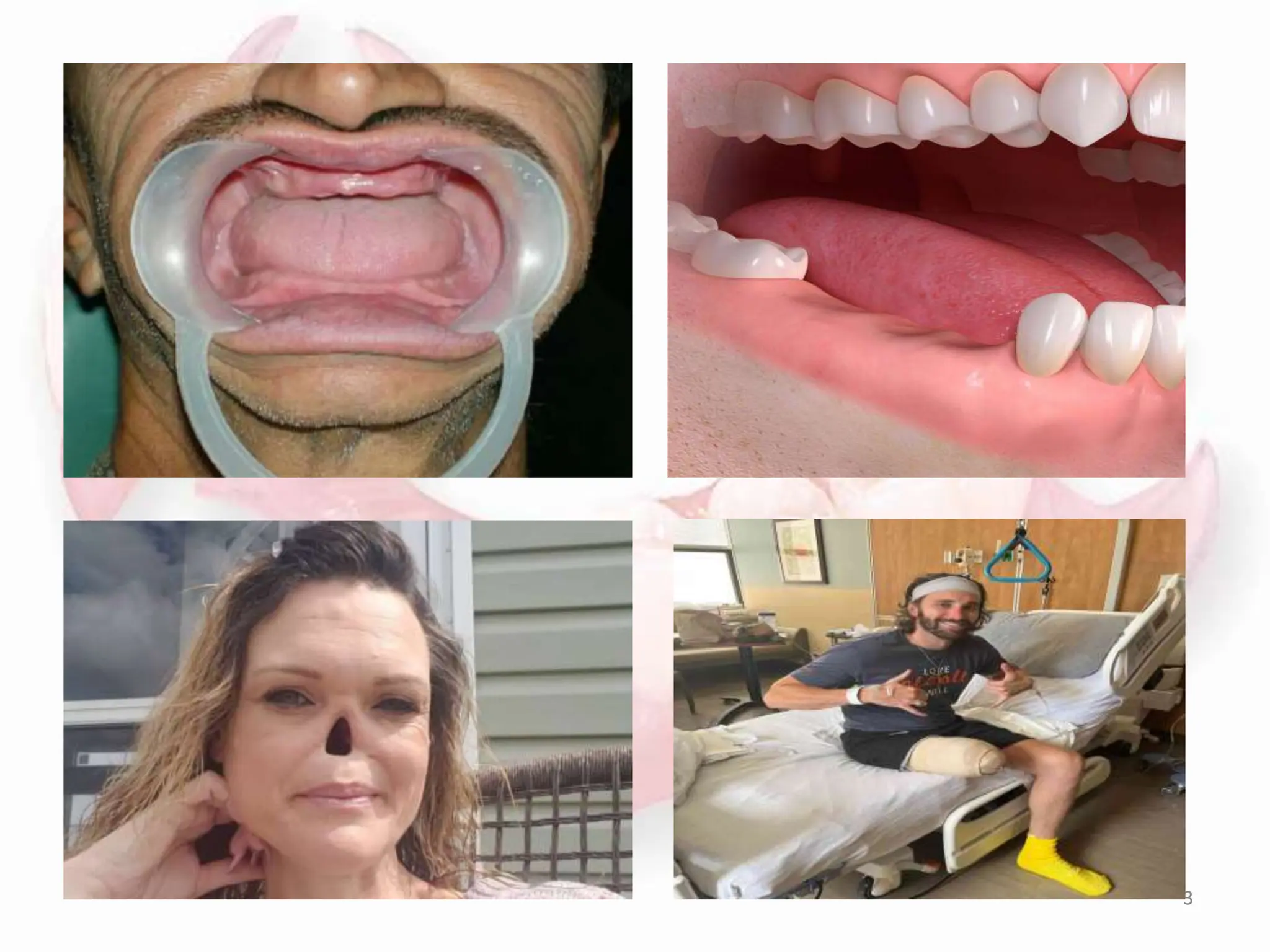 01- INTRODUCTION AND CLASSIFICATION PARTIAL DENTURE.pptx