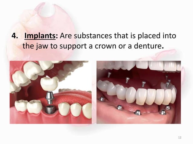 01- INTRODUCTION AND CLASSIFICATION PARTIAL DENTURE.pptx | Dental ...