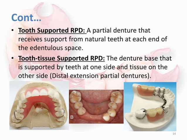 01- INTRODUCTION AND CLASSIFICATION PARTIAL DENTURE.pptx | Dental ...